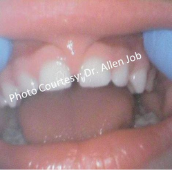 Laser Lip Tongue Tie Release Pediatric Dentist San Diego Ca All